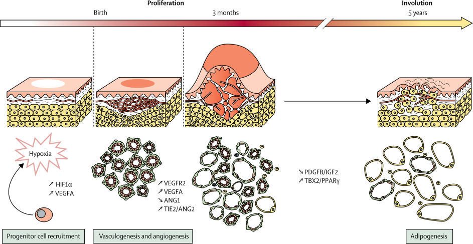 Hemangioma Infantil :: Referências Radiológicas